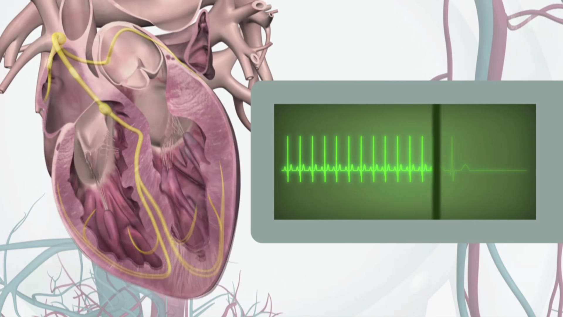 Herzrhythmusstörungen - Wenn das Herz stolpert und rast: Wann zum Arzt ...