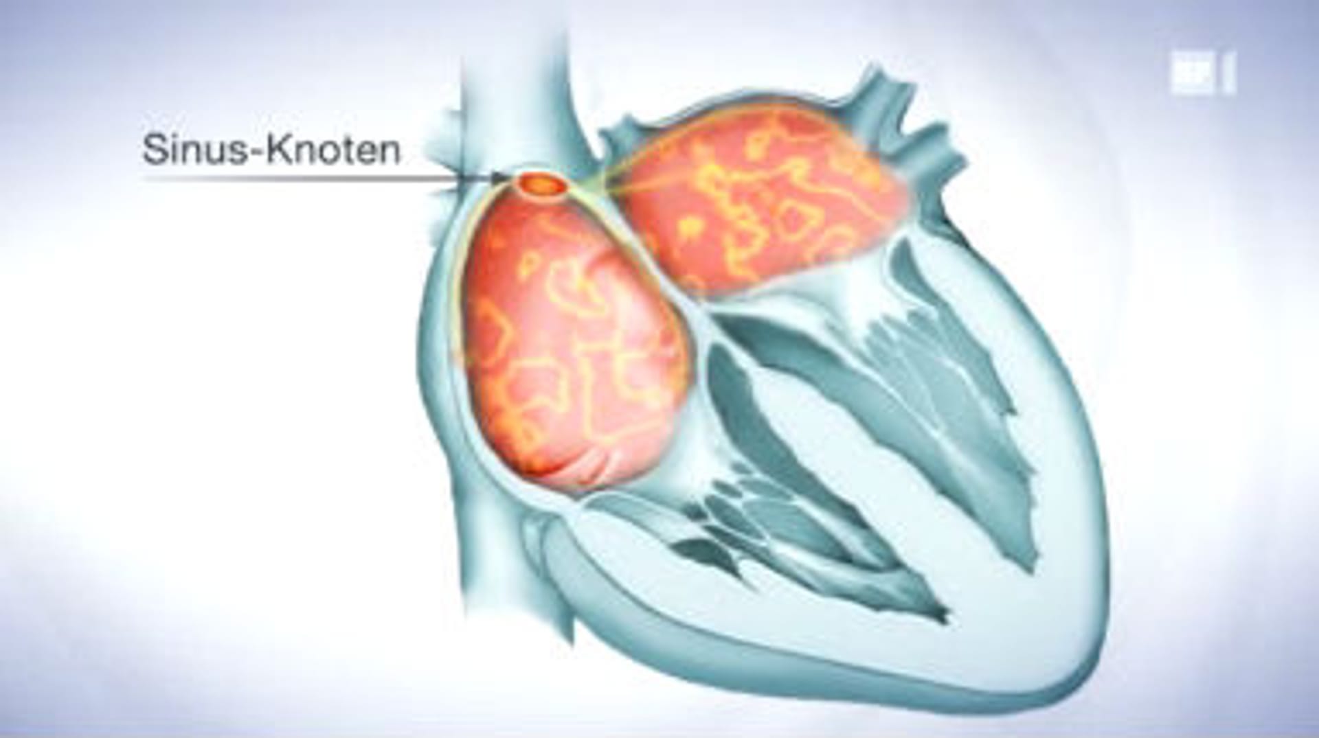 Herzrhythmusstörungen - Wenn das Herz stolpert und rast: Wann zum Arzt ...