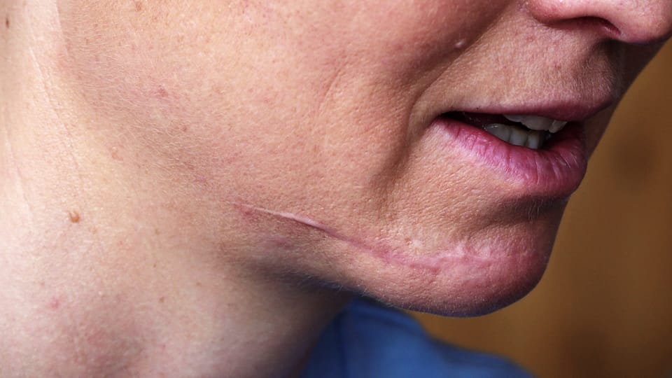 Narbenbehandlung: Was hilft wirklich gegen störende Narben? - Puls ...