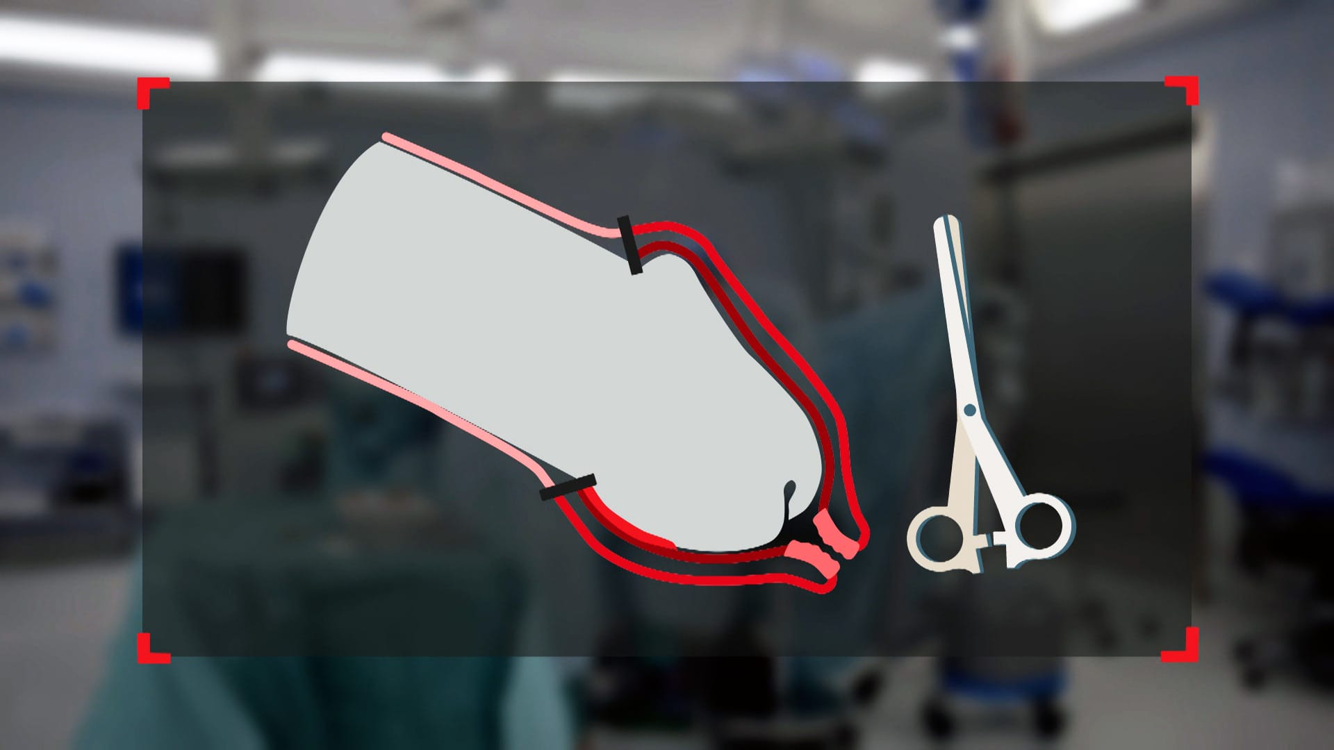 Männliche Beschneidung - Blackbox Beschneidung: Wann ist der Eingriff ...