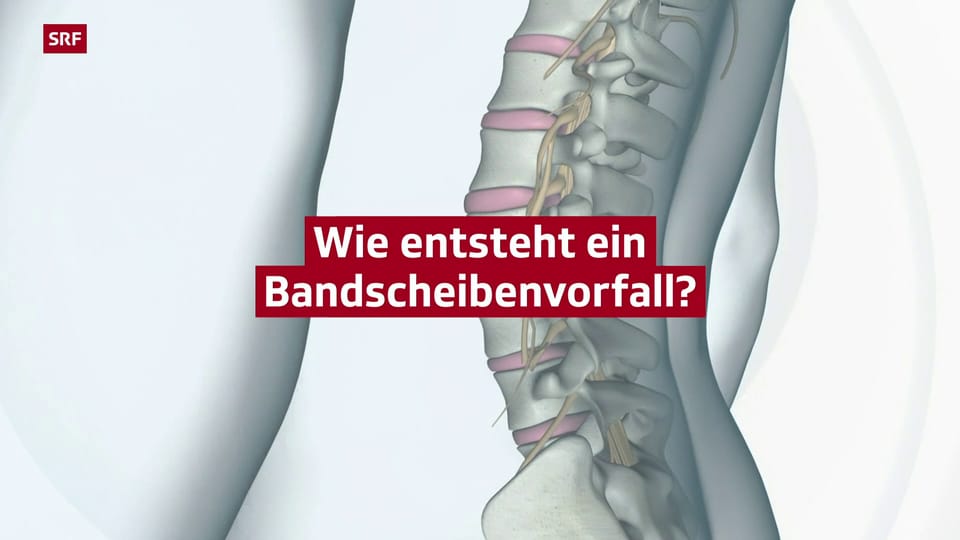 Wissen für alle – Wie entsteht ein Bandscheibenvorfall? - SRF Videos ...
