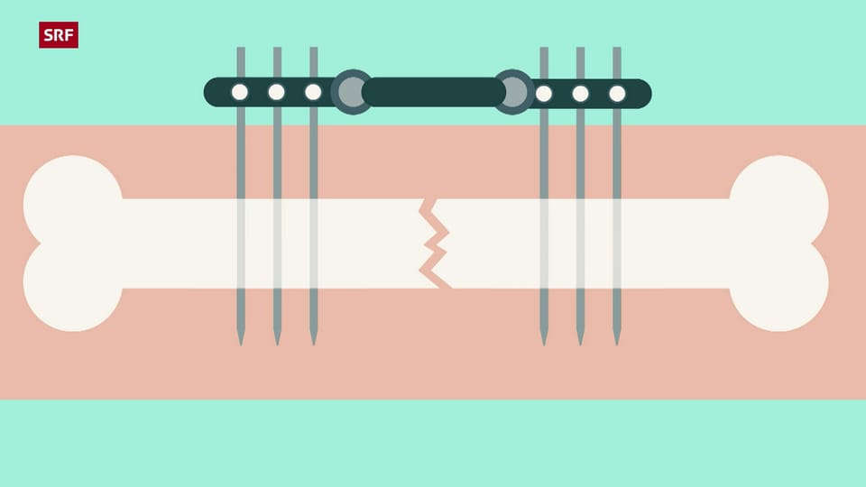 Wie heilt ein Knochenbruch? - SRF Kids News - Play SRF
