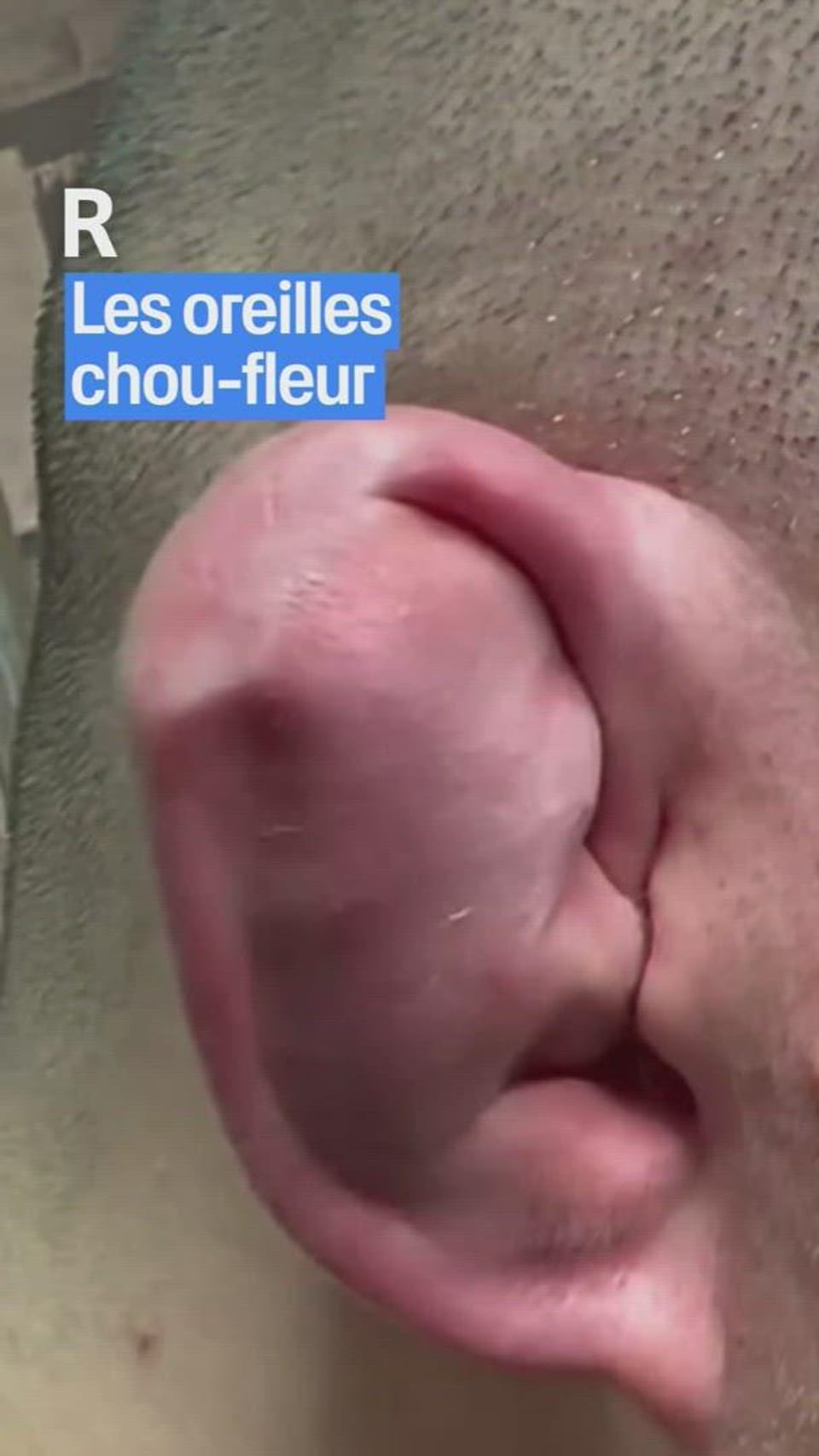 Les oreilles chou-fleur - Verticale RTSinfo - Play RTS