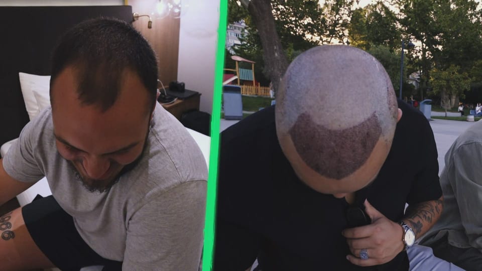 Immersion - Chirurgie en Turquie : on vous dit tout sur la calvitie ...